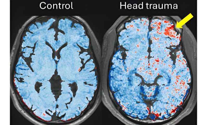 Study: Repeated Small Hits to Head Can Damage Brain Blood Vessels